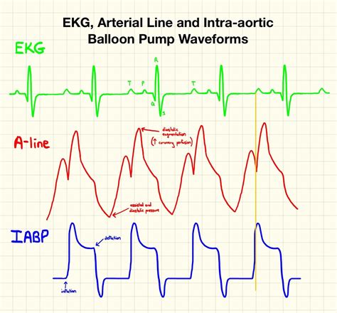 Intra Aortic Balloon Pump Waveform
