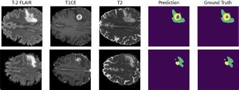 Figure 2 From Multiclass Mri Brain Tumor Segmentation Using 3d