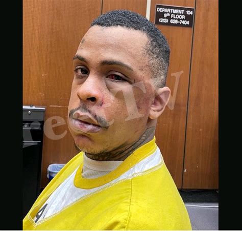 Nipsey Hussle Murder Suspect Eric Holder Displays Injuries After He Was
