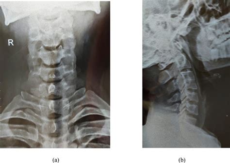 Anteroposterior Lateral Views Of Radiographs Showing C3 C4 Block Download Scientific Diagram