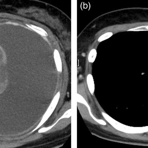 Tepotinib Was Administered With A Reduction In Tumor Size And Decrease Download Scientific