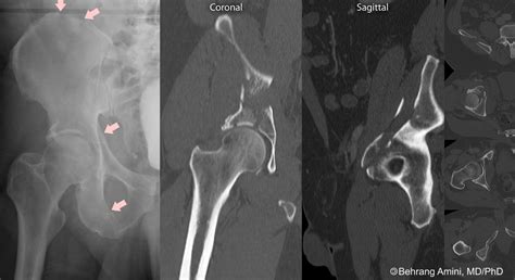Roentgen Ray Reader Anterior Column Acetabular Fracture