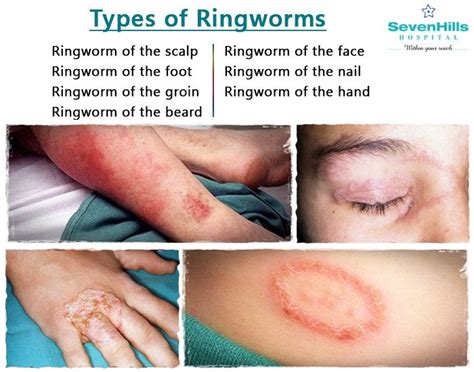 Are There Different Types Of Ringworm At Adam Winland Blog