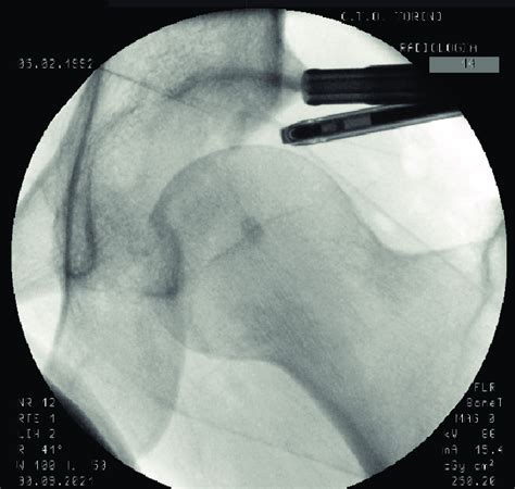 A Intraoperative Fragment Identification B Fluoroscopic View Of Download Scientific