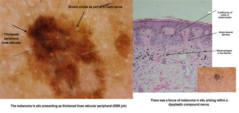 Dermoscopy Made Simple Melanoma In Situ Mainly