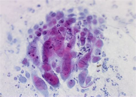 Herpes Simplex Virus Hsv Mypathologyreport