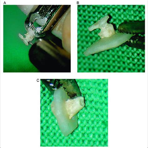 Ossicle Cartilage Composite Graft Occg For Partial Ossicular Download Scientific Diagram