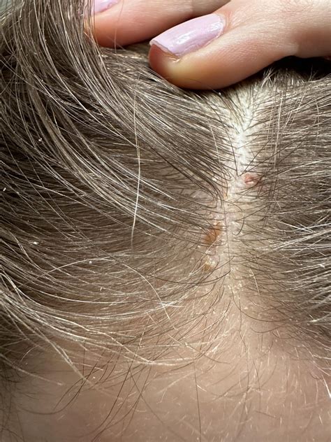 Dandruff Buildup Dry Scalp Seb Derm R Sebderm