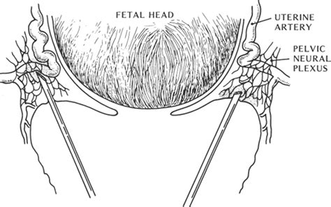 Neural Blockade For Obstetrics And Gynecologic Surgery Anesthesia Key