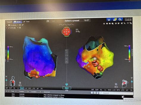 Cti Flutter With Affera Pulsed Field Ablation Catheter Using Radio… Irfan Khurram Facc Fhrs