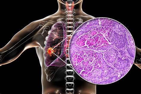 Ai Insights Into Tumor Heterogeneity