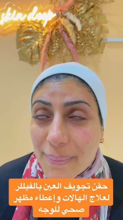 علاج تجويف تحت العين بالفيلر الهالات السوداء Youtube