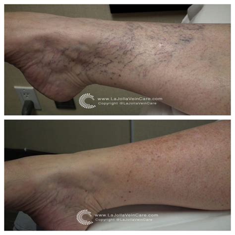 Vein And Vascular Treatment Spider Veins