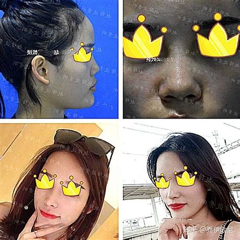 郑州隆鼻哪家医院好？有推荐的隆鼻医生吗？ 知乎