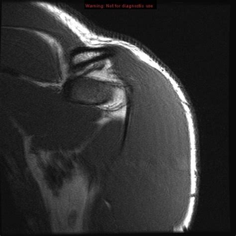Shoulder Mri Coronal 3 Diagram Quizlet