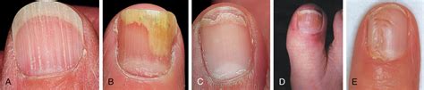 Toenail Abnormalities Clinical Tree