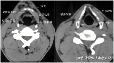 喉的ct解剖 知乎