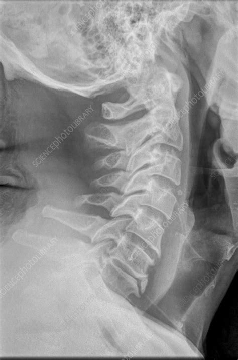 Dens Fracture Of The Spine X Ray Stock Image C056 4039 Science Photo Library