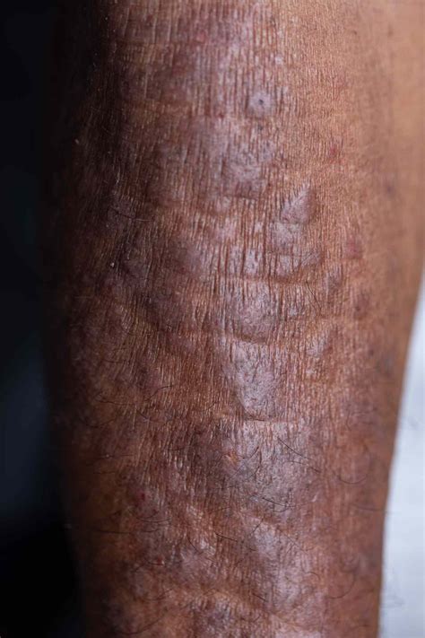 Eczema Symptoms Black Skin