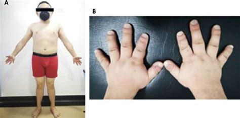 Pseudohypoparathyroidism An Endocrine Orphan Disease Case Report