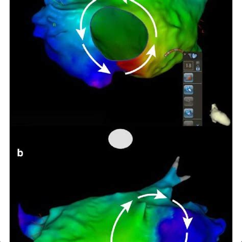 Complete Ablation Lines A Atrial Flutter Was Terminated When Second