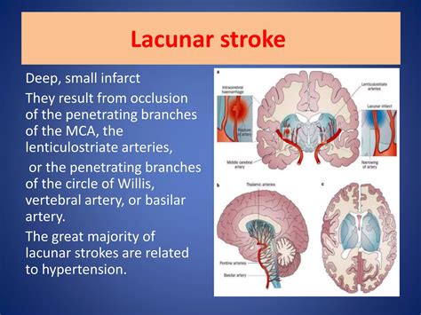 Stroke Pptx Brain And Nervous System Disorders Diseases And