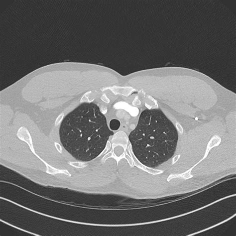 Bilateral Atelectasis Radiopaedia 48666 53675 Axial Lung Window Nc