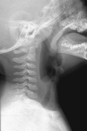 Hypopharynx Xray