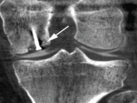 A The Spectct Scan Of The Knee Joint Shows Clear Articular