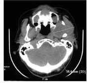An Axial Post Contrast Ct Scan Shows That The Tumor Has Grown In The