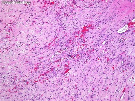 Nodular Fasciitis Treatment