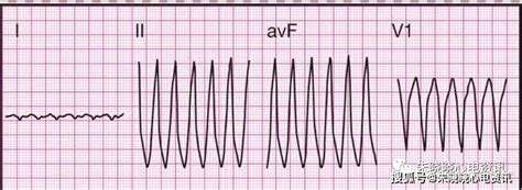 Android 心率波形图 心率波动图daleiwang的技术博客51cto博客 Android 心率波形图 心率波动图daleiwang的技术博客51cto博客