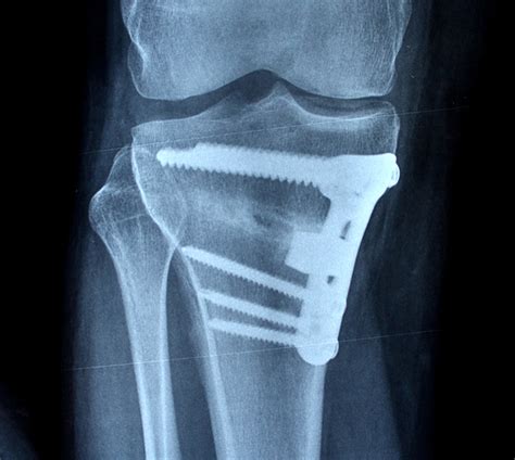 Osteotomía