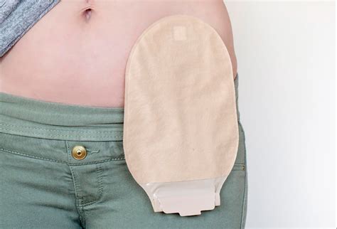 Ostomy Bag Vs Colostomy Bag 3 Differences And Essential Tips