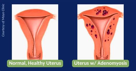 Adenomyosis Symptoms Causes And Treatment Options Colorado Ecco Medical