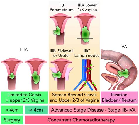The Radiology Assistant Cervical Cancer Mr Staging