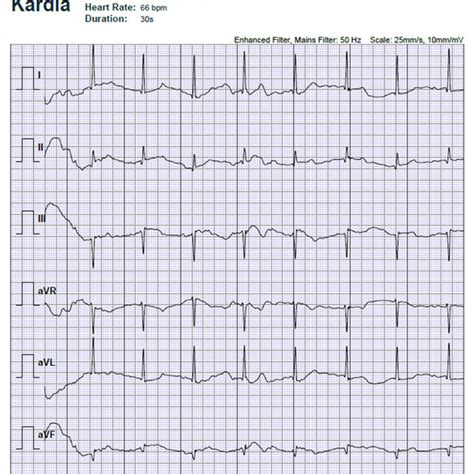 6 Lead Ecg Device Automatic Output Download Scientific Diagram