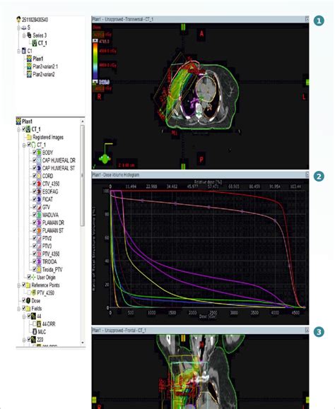 Figure Nr 4 Ebrt Using 3d Crt With An Isodose Of 95 And