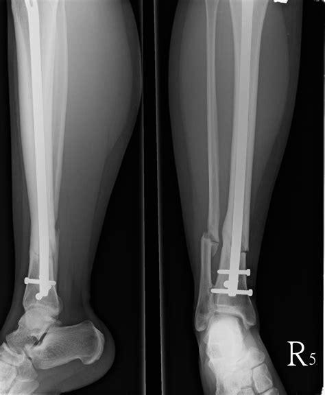Big Bad Y O Male Patient Tibia Fracture With Partial Nonunion
