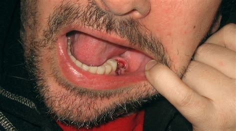Wisdom Teeth Faq Express Dentist