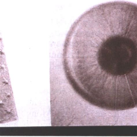 Case 3 Iris Mammillations Overlying Naevus Download Scientific Diagram Case 3 Iris Mammillations Overlying Naevus Download Scientific Diagram