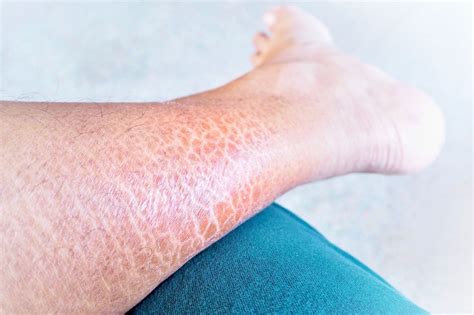 25 Facts About Dominant Ichthyosis Vulgaris