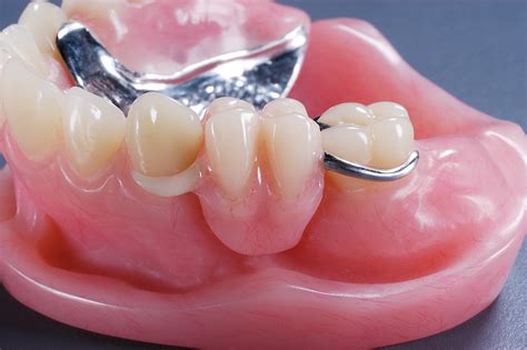 Clasp Design For Removable Partial Denture At Hamish Geake Blog