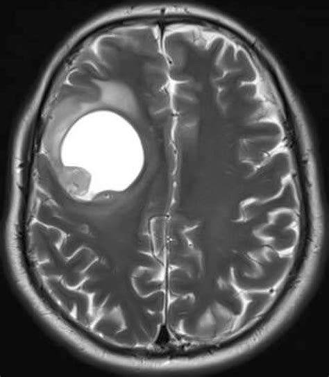 Neurocysticercosis Mimics And Chameleons Practical Neurology