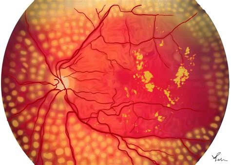 Pterygium