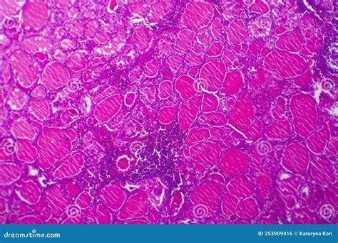 Simple Goiter Light Micrograph Royalty Free Stock Image 253910788