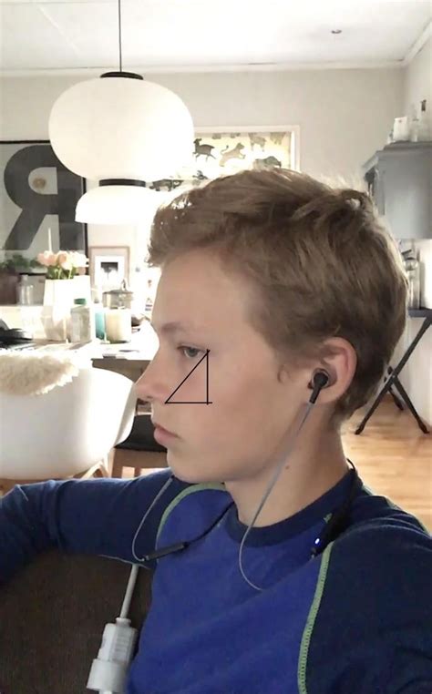 Premolar Extraction Retraction Victim What Should I Do Rjawsurgery