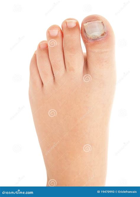 Broken Big Toe With Nail Detachment Stock Image Image Of Injury Foot