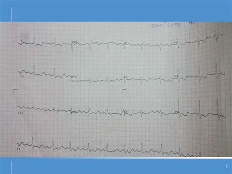 Atrial Flutter Afl Management Principals Pptx Ear Nose And Throat Conditions Diseases