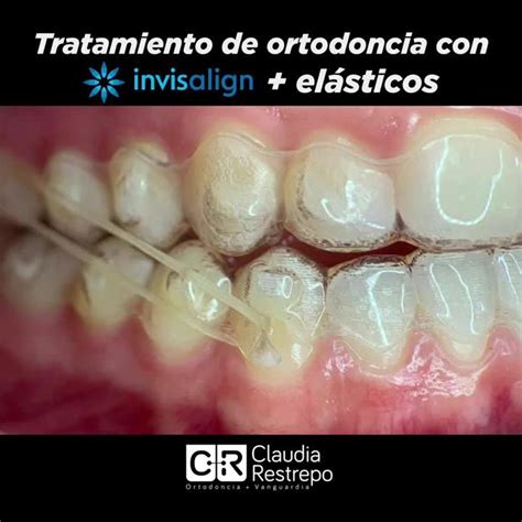 Tratamiento De Elásticos Con Invisalign Para Corrección De Mordida ¡ortodoncia